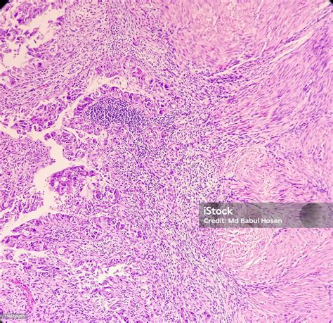 Uterus Wall Simple Endometrial Hyperplasia Show Revealing Features Of