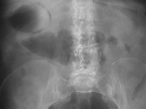 Cholelithiasis X Ray