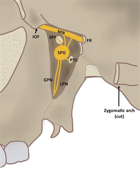 Schematic Anatomical Pathways Of The Maxillary Nerve Block Maxillary Download Scientific
