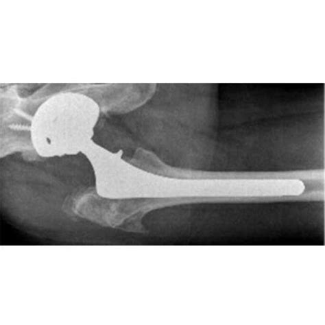 Pdf Femoral Bone Loss In Revision Total Hip Arthroplasty Evaluation