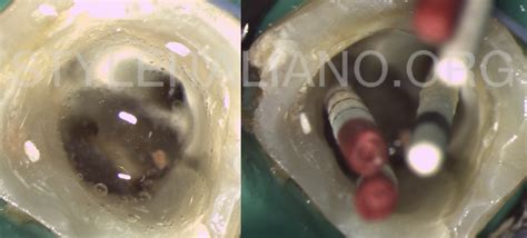 Management Of Iatrogenic Root Perforations A Case Report Style