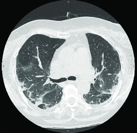 Second Patient Thorax Computed Tomography Scan Download Scientific