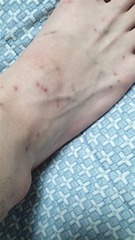 관계 후 손 발 피부 발진 생김 지식in
