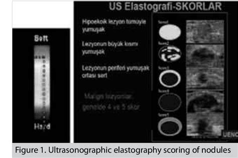 Figure 1 From The Predictive Value Of Elastography In Thyroid Nodules