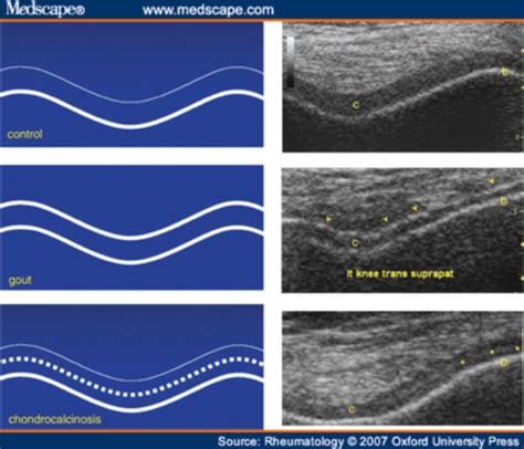 Gout Flashcards Quizlet