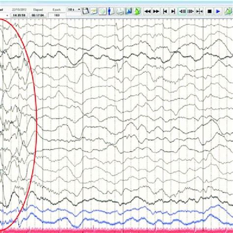 Electroencephalography Eeg Showed Generalized Slowing And Multifocal