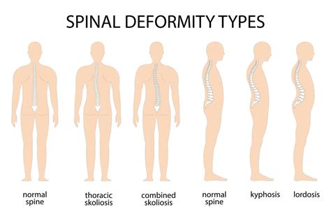 Kyphosis Vs Lordosis 1920x1080