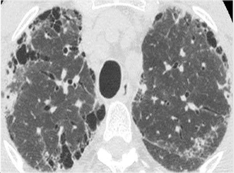 Figure 1 From Combined Pulmonary Fibrosis And Emphysema Cpfe Does