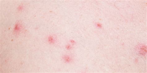 Difference Between Acne And Pimples And How To Reduce It The Pink Foundry