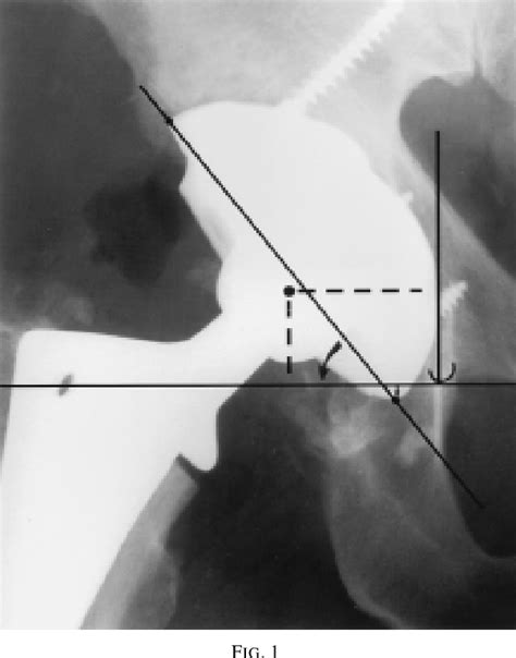 Figure 1 From Acetabular Revision With Use Of A Bilobed Component