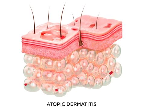 Premium Photo Eczema 3d Illustration Of The Crosssection Of Skin