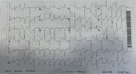 Digoxin Ekg