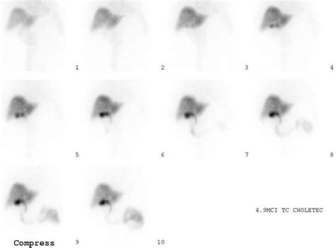 Understanding Hida Scan Results