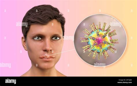 Cold Sore On The Lip Of A Man And Closeup View Of Herpes Simplex