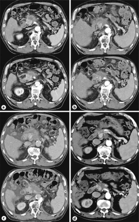 Abdominal Ct Findings Of Case 1 A Ct At Admission B Ct 8 Months After