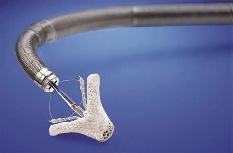 Teer Mitraclip Pascal Keyhole Heart Surgery London Uk