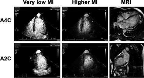 Heart Noncompaction