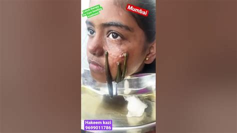 Is Leech Therapy Good For Face What Is A Cosmetic Leech Leechtherapyleechayurveda