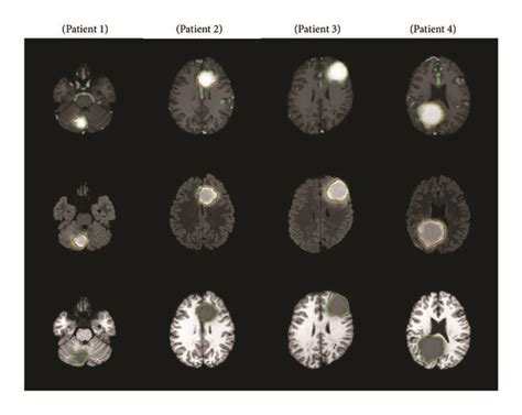 Results Of Segmentation By Level Set Method In Mri Images And The Download Scientific Diagram