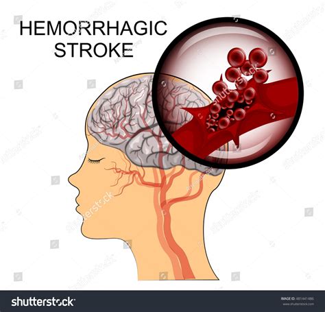 Illustration Rupture Vessel Hemorrhagic Stroke Insult Stock Vector