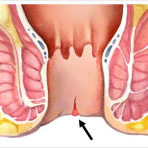 Fissure Treatment Gastrocare Hospital