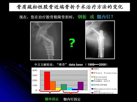 肱骨近端骨折髓内钉治疗，建议收藏！ 德医学院 助力医学教育发展！