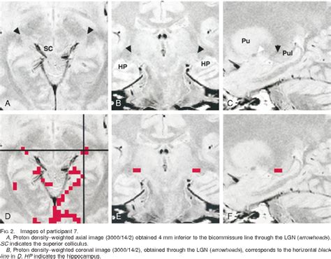 Figure 2 From Lateral Geniculate Nucleus Anatomic And Functional