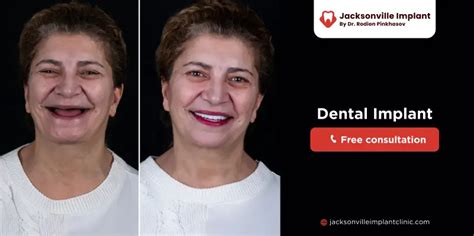 Understanding The Risk Can Dental Implants Get Infected