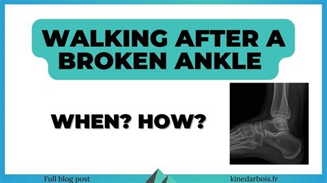How To Start Walking After A Broken Ankle Physio Tips