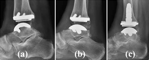 Computed Tomography Derived Patient Specific Instrumentation Total
