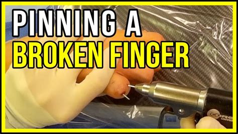 Constant Pins And Needles In My Thumb At Jasper Vogel Blog