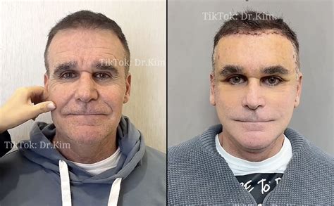 Tiktoks Elusive ‘dr Kim Shares Post Op Pics Of 50 000 Facelift
