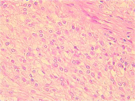 The Tumor Is Composed Of Uniform Round Or Spindle Cells With A Pale