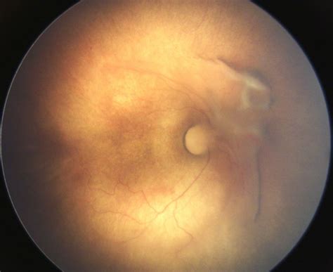 Topic Zone 1 Stage 4a Rop Treated In A Different Way Funny Title Zone