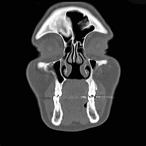 A Frontal Ct Scan Of The Maxilla Showing A Visible Bone Defect Hard
