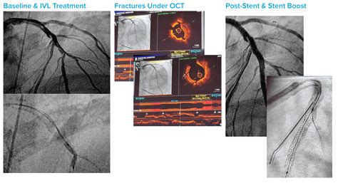 Diffuse Lad Case Featured In Main Arena At Pcr18 Shockwave Medical