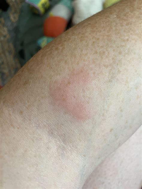 Weird Bumpy Rash This Showed Up Saturday Kind Of Out Of The Blue It