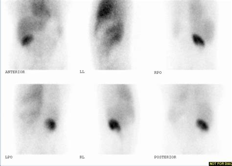 Nuclear Medicine Dmsa Renal Scan Ultrasonography Spect Ct Nephrology Ramin Sadeghi