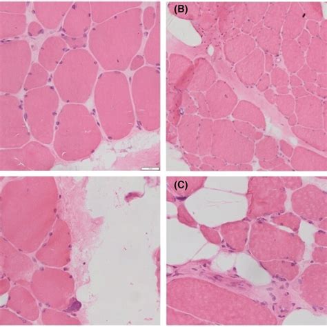 Histopathology Of Right Vastus Lateralis Muscle Download Scientific
