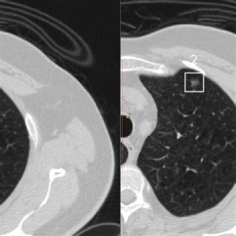 Summary Dicom Of Lung Nodule Analysis And Emphysema Quantification Download Scientific Diagram