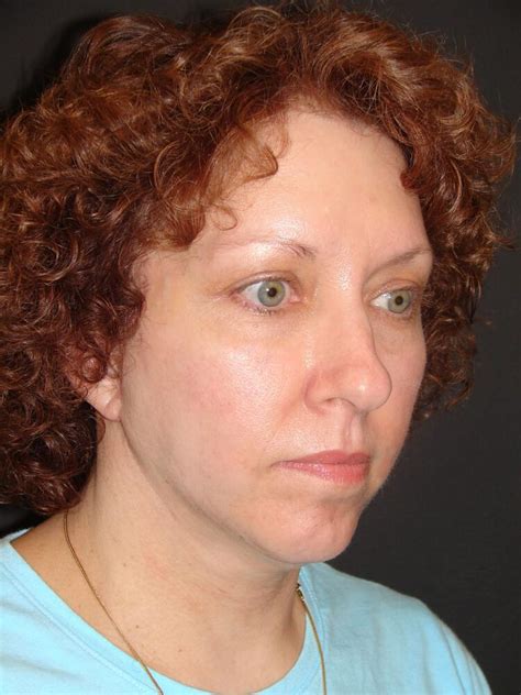 Before After Brow Lift Procedures In Rancho Santa Margarita CA