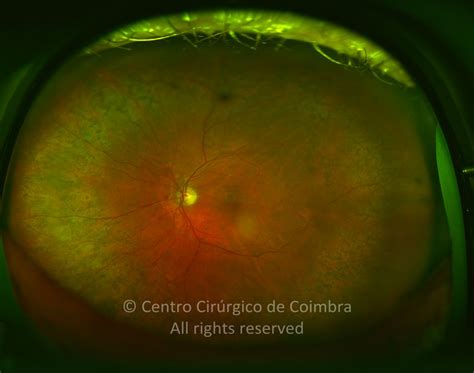 Choroidal Detachment Atlas Rl Eye