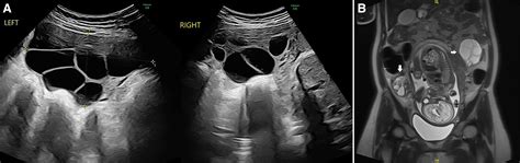 Hyperreactio Luteinalis Associated With Nonimmune Fetal Hydrops