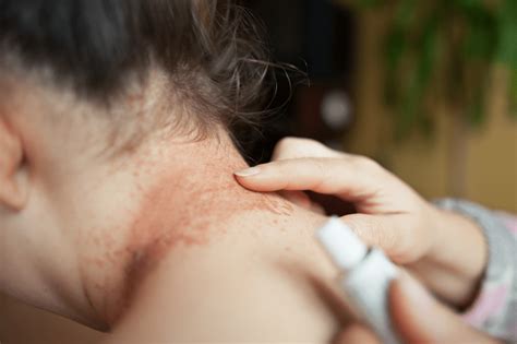 Ichthyol Uses And Benefits Sixtus Italia