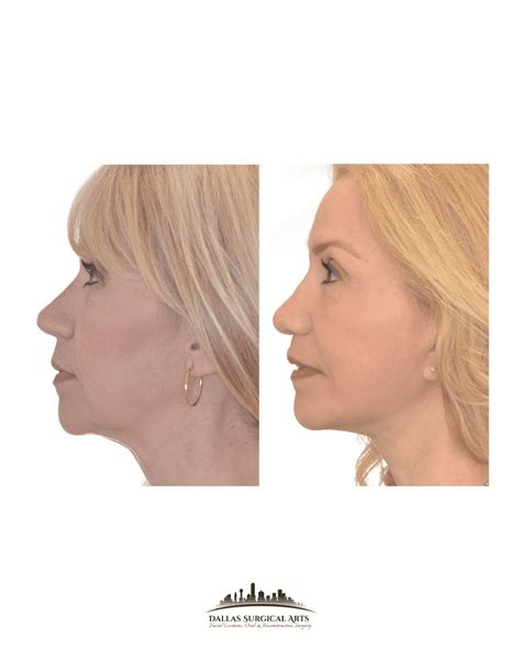 Total Joint Replacement Faqs Answers To Common Questions