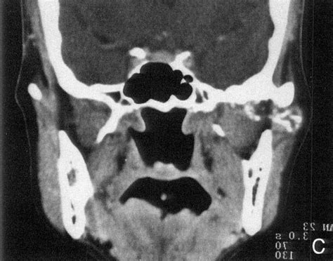 第六节 滑膜软骨瘤病 颌面颈部疾病影像学图鉴
