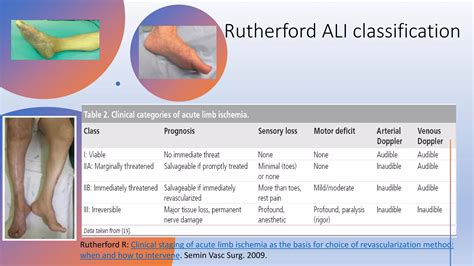 Neo Innovation In Limb Ischemia Management Ppsx