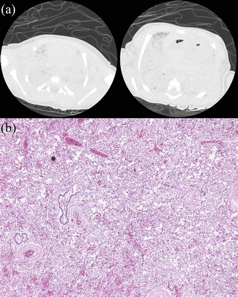 A Case Of Sudden And Unexplained Death With Bilateral Diffuse Lung Download Scientific Diagram