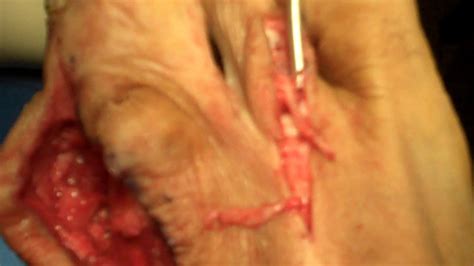 Elephantiasis Youtube