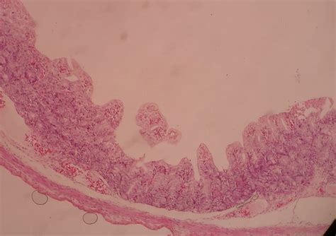 Enteritis No Supurativa Ligera Con Acortamiento Fusión De